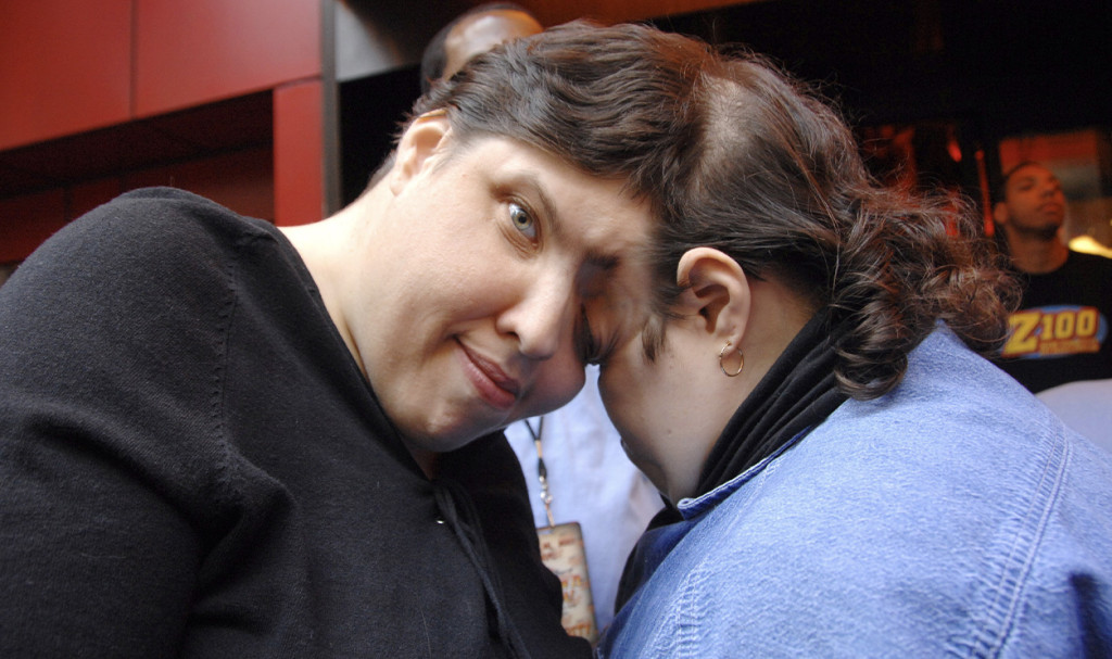 Conjoined Twins: Lori and George Schappell