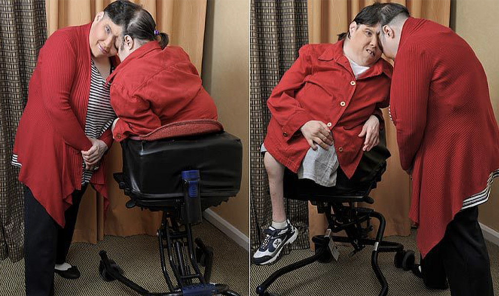 Conjoined Twins: Lori and George Schappell