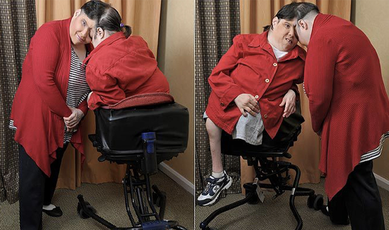 Conjoined Twins: Lori and George Schappell